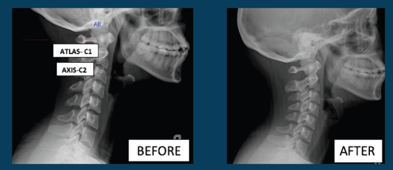 The Dynamic Duo of the Spine: Atlas & Axis - Barrett Chiropractic